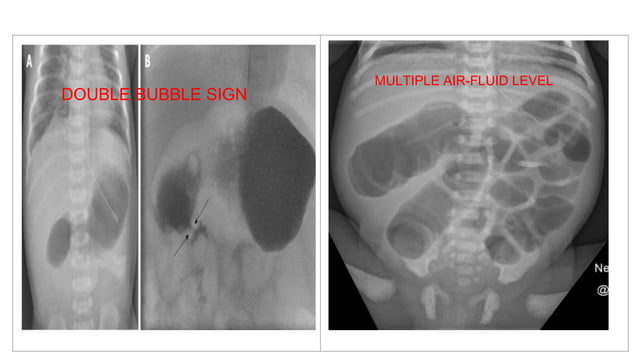 bilious vomiting in newborn.pptx | Digestive Disorders | Diseases and ...