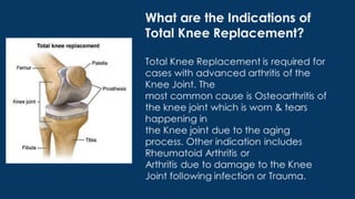 Total Knee Replacement | PPTX