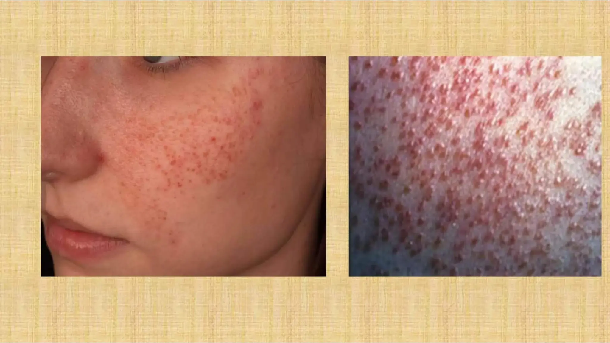 Untitled presentation for cutaneous tuberculosis | PPT