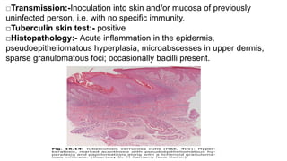 Untitled presentation for cutaneous tuberculosis | PPT
