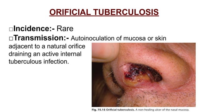 Untitled presentation for cutaneous tuberculosis | PPT