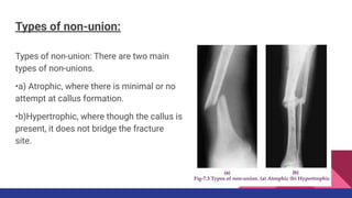 Late complications of fracture presentation.pdf | Death, Injury, or ...