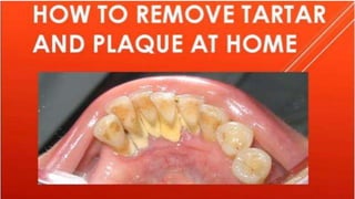 How to remove plaque and tartar at home? | PPTX