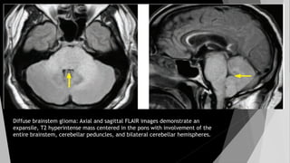 neurology tumors cysts and disesaes partb 1 | PPTX