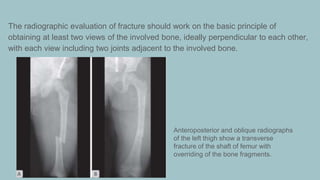 appendicular trauma in radiology. .pptx