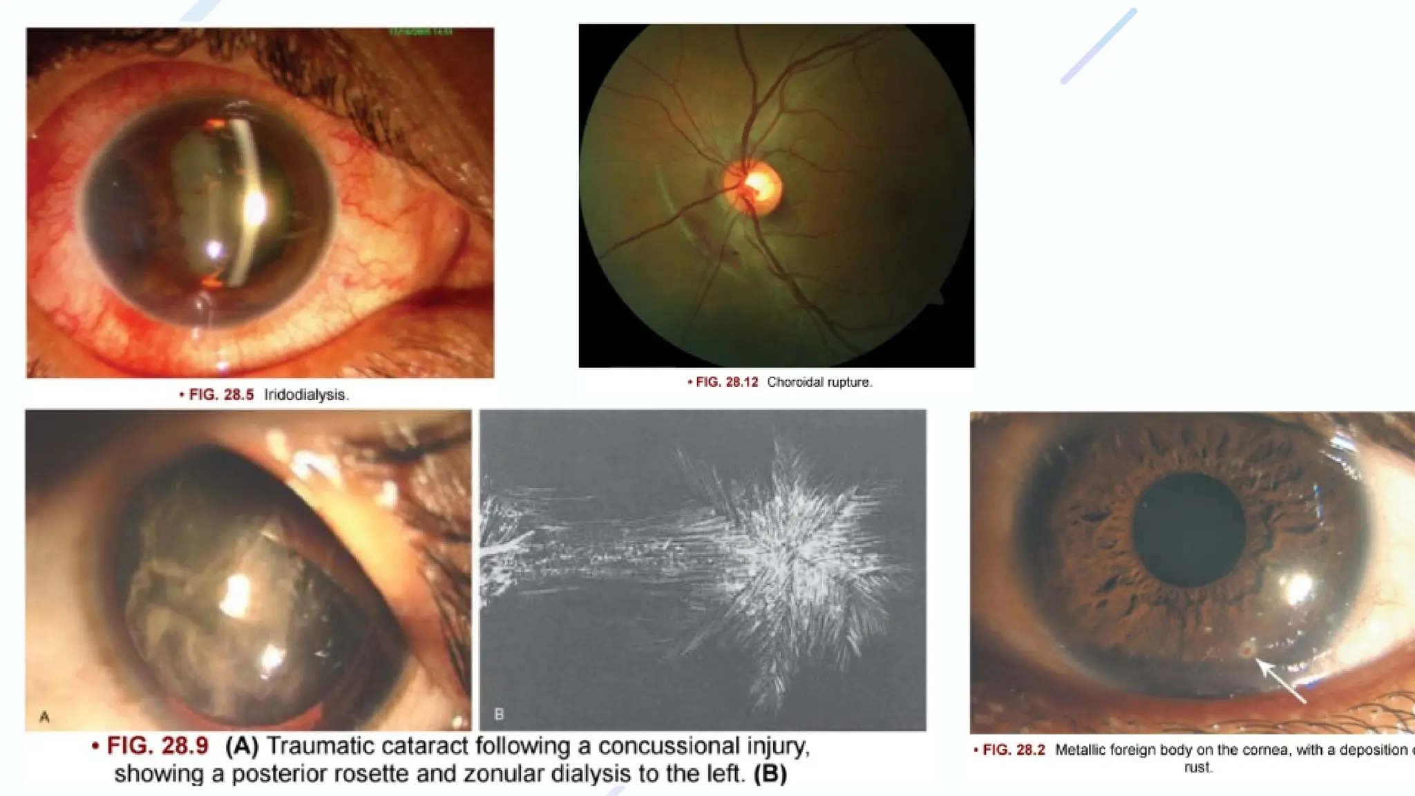 Ocular trauma classification..........pdf