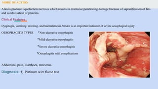 Mushroom poisoning and caustics-inorganic acids and alkali | PDF