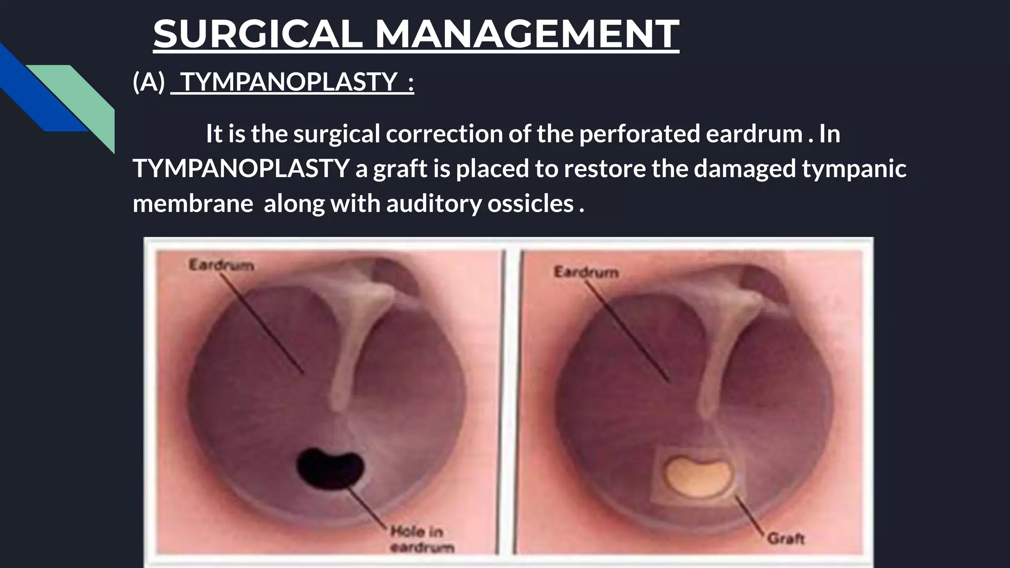TYMPANIC MEMBRANE PERFORATIONS | PDF | Ear, Nose and Throat Conditions ...
