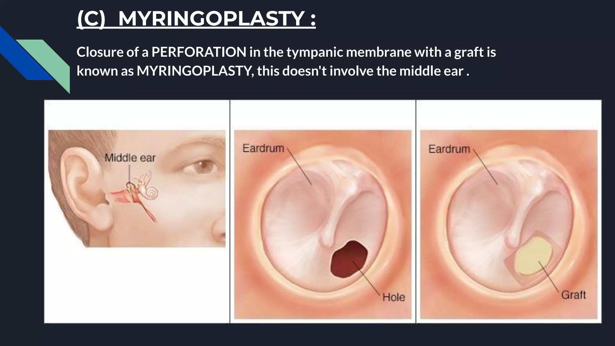 TYMPANIC MEMBRANE PERFORATIONS | PDF