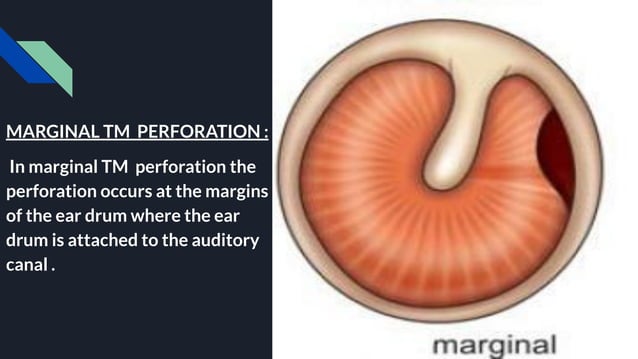 TYMPANIC MEMBRANE PERFORATIONS | PDF | Ear, Nose and Throat Conditions ...