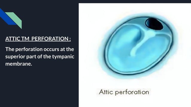 TYMPANIC MEMBRANE PERFORATIONS | PDF | Ear, Nose and Throat Conditions ...