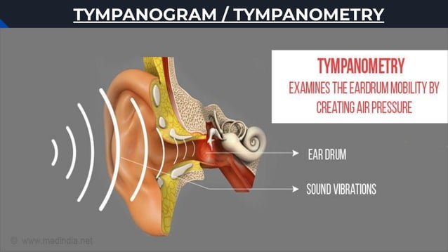 TYMPANIC MEMBRANE PERFORATIONS | PDF | Ear, Nose and Throat Conditions ...
