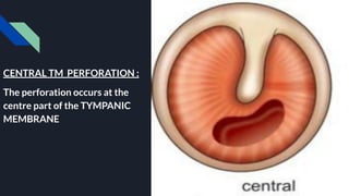 TYMPANIC MEMBRANE PERFORATIONS | PPT