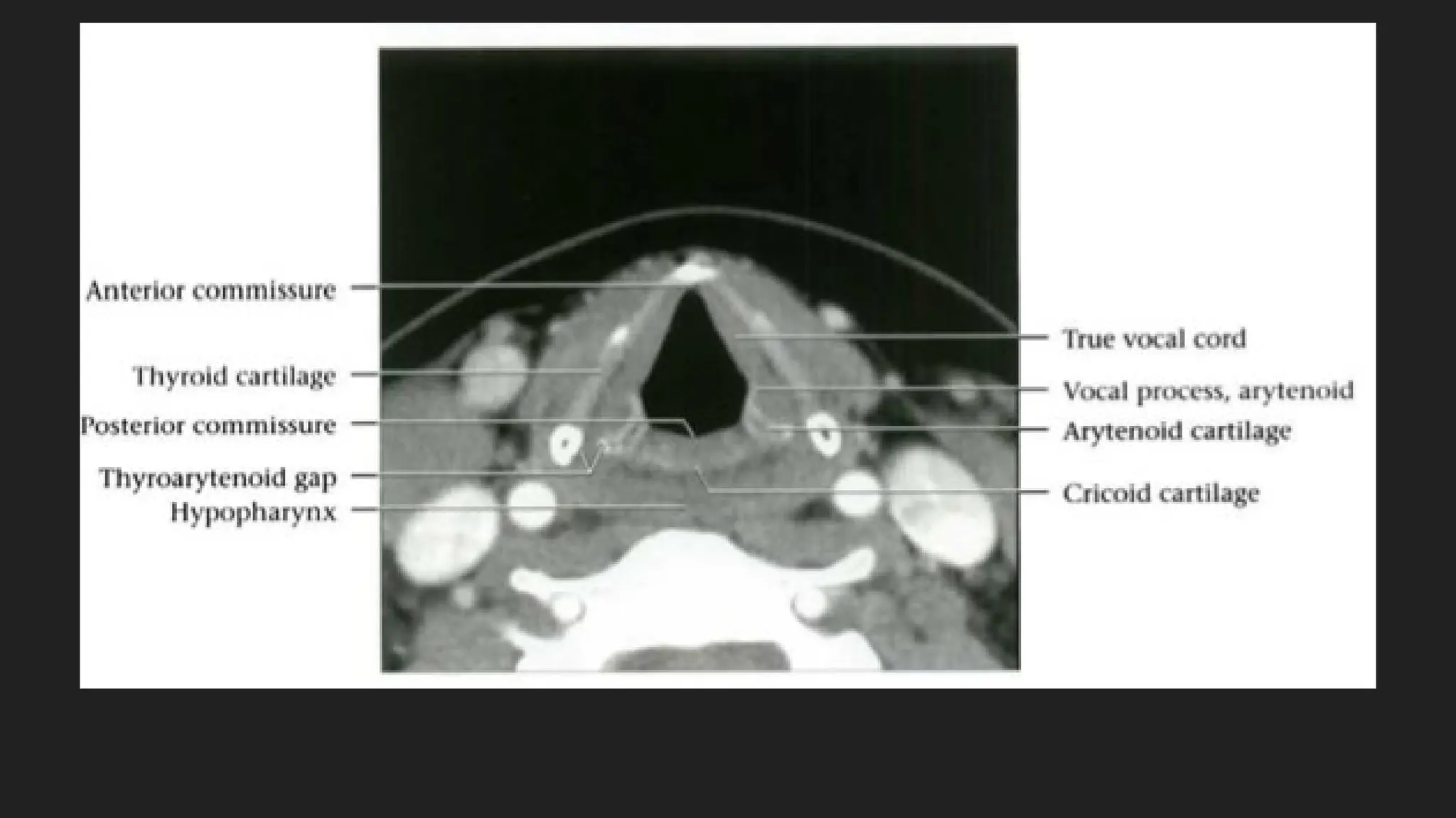 larynx and hypopharynx radiology anatomy | PPTX
