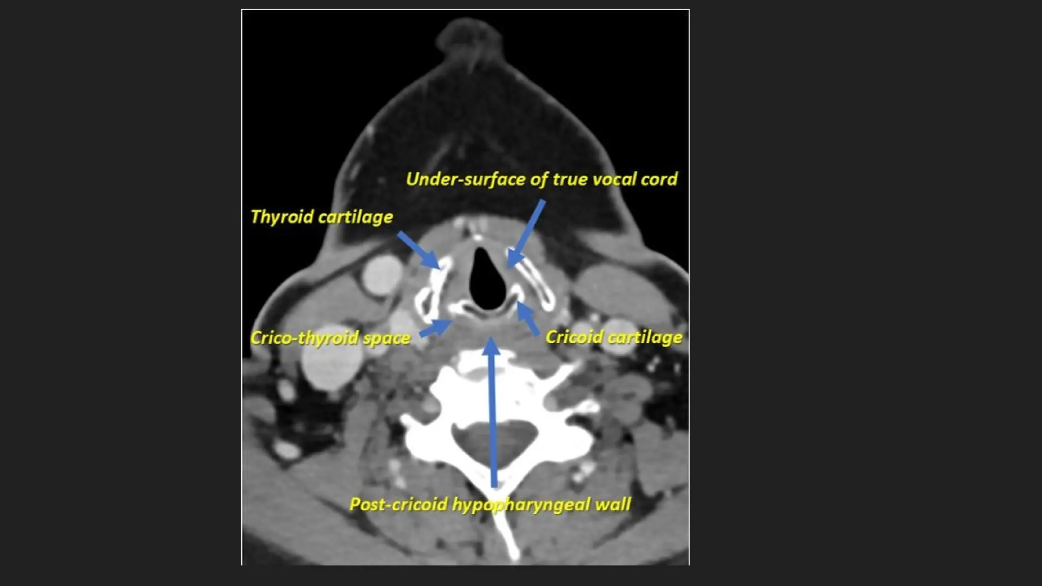 larynx and hypopharynx radiology anatomy | PPTX