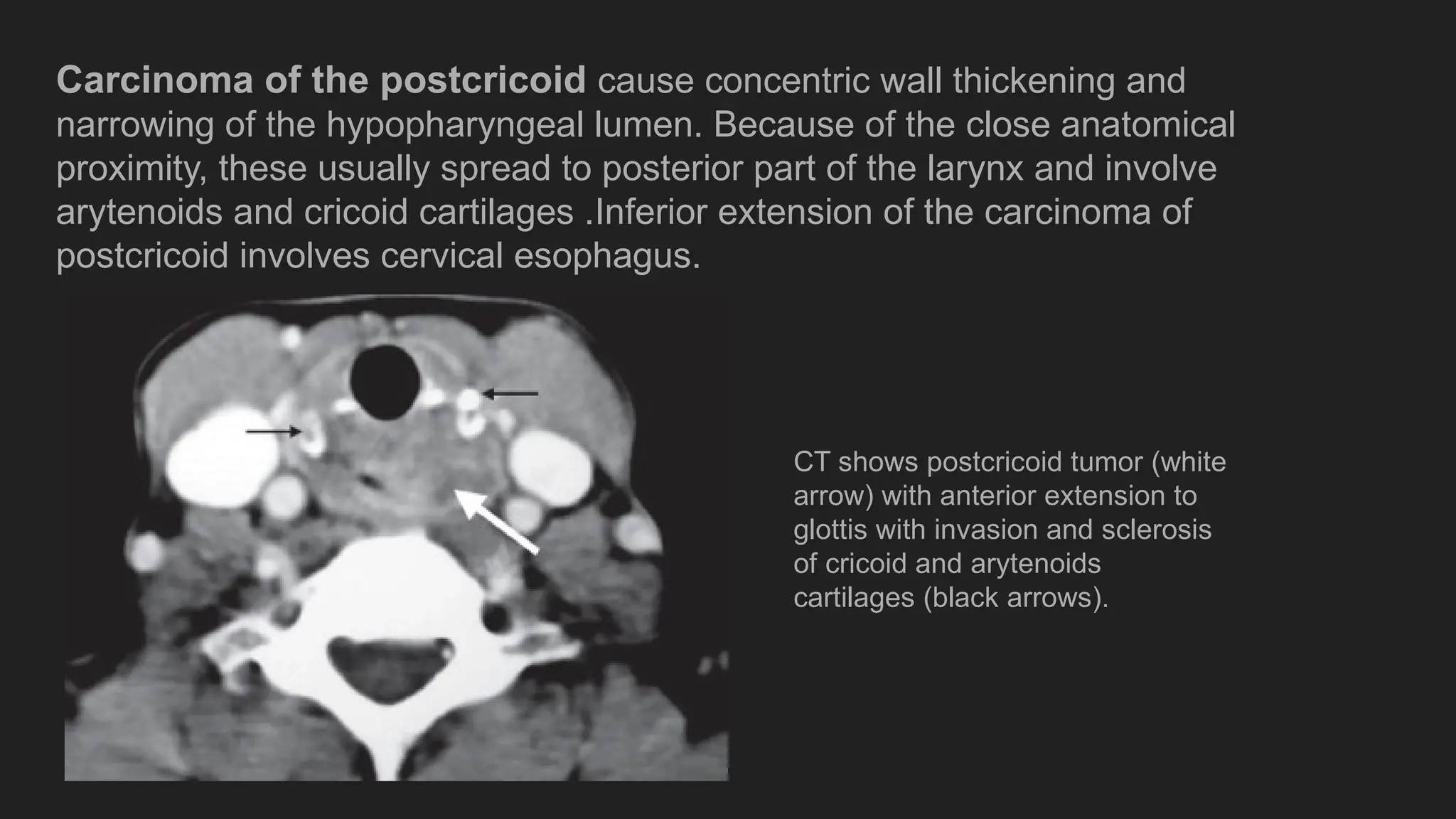 larynx and hypopharynx radiology anatomy | PPTX