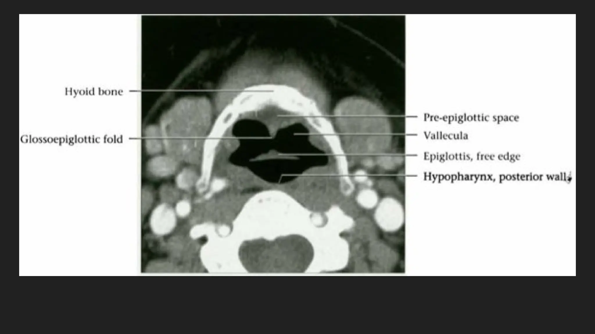 larynx and hypopharynx radiology anatomy | PPTX