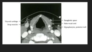 larynx and hypopharynx radiology anatomy | PPTX