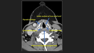 larynx and hypopharynx radiology anatomy | PPTX