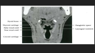 larynx and hypopharynx radiology anatomy | PPTX
