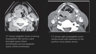 larynx and hypopharynx radiology anatomy | PPTX