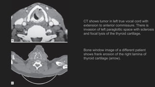 larynx and hypopharynx radiology anatomy | PPTX