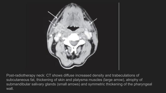 larynx and hypopharynx radiology anatomy | PPTX | Thyroid Disorders ...