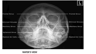 paranasal sinuses radiology pathology anatomuy | PPTX