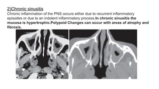 paranasal sinuses radiology pathology anatomuy | PPTX