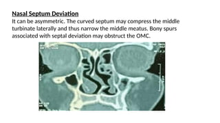 paranasal sinuses radiology pathology anatomuy | PPTX