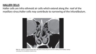 paranasal sinuses radiology pathology anatomuy | PPTX