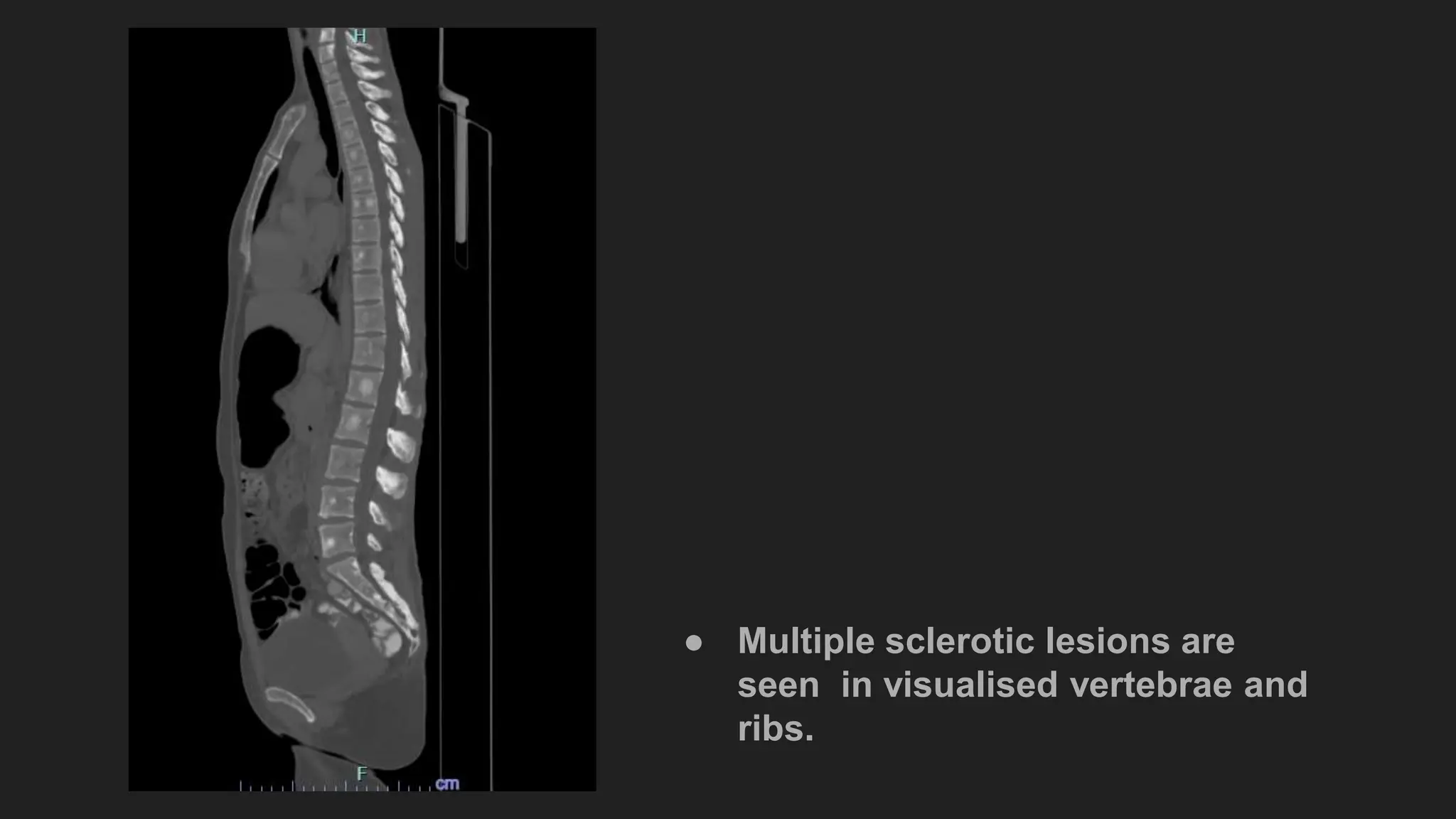 case presentation of tuberous sclerosis in a 30 year old woman | PPTX