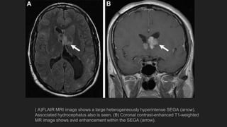 case presentation of tuberous sclerosis in a 30 year old woman | PPTX