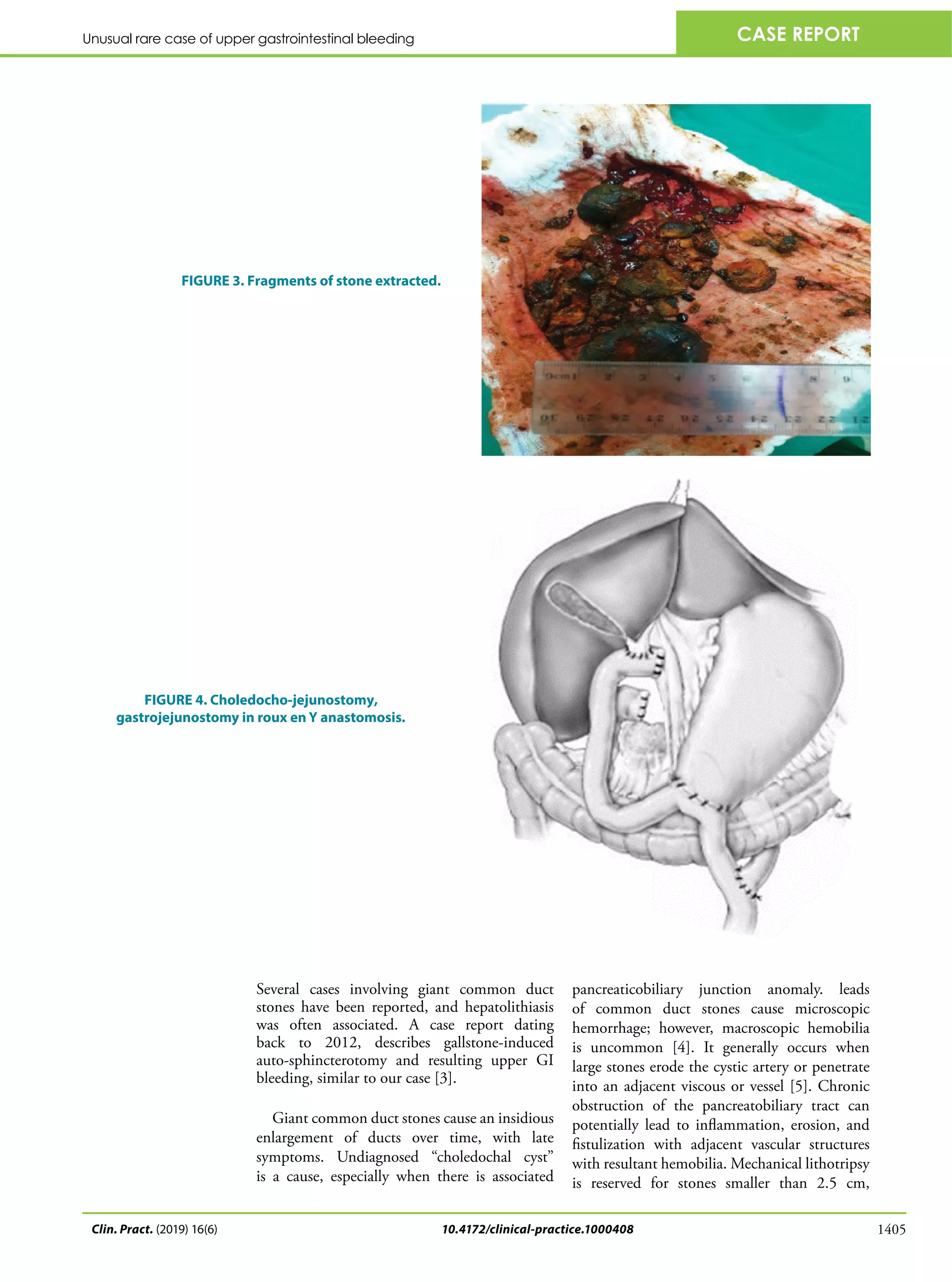 Unusual rare case of upper gastrointestinal bleeding | PDF