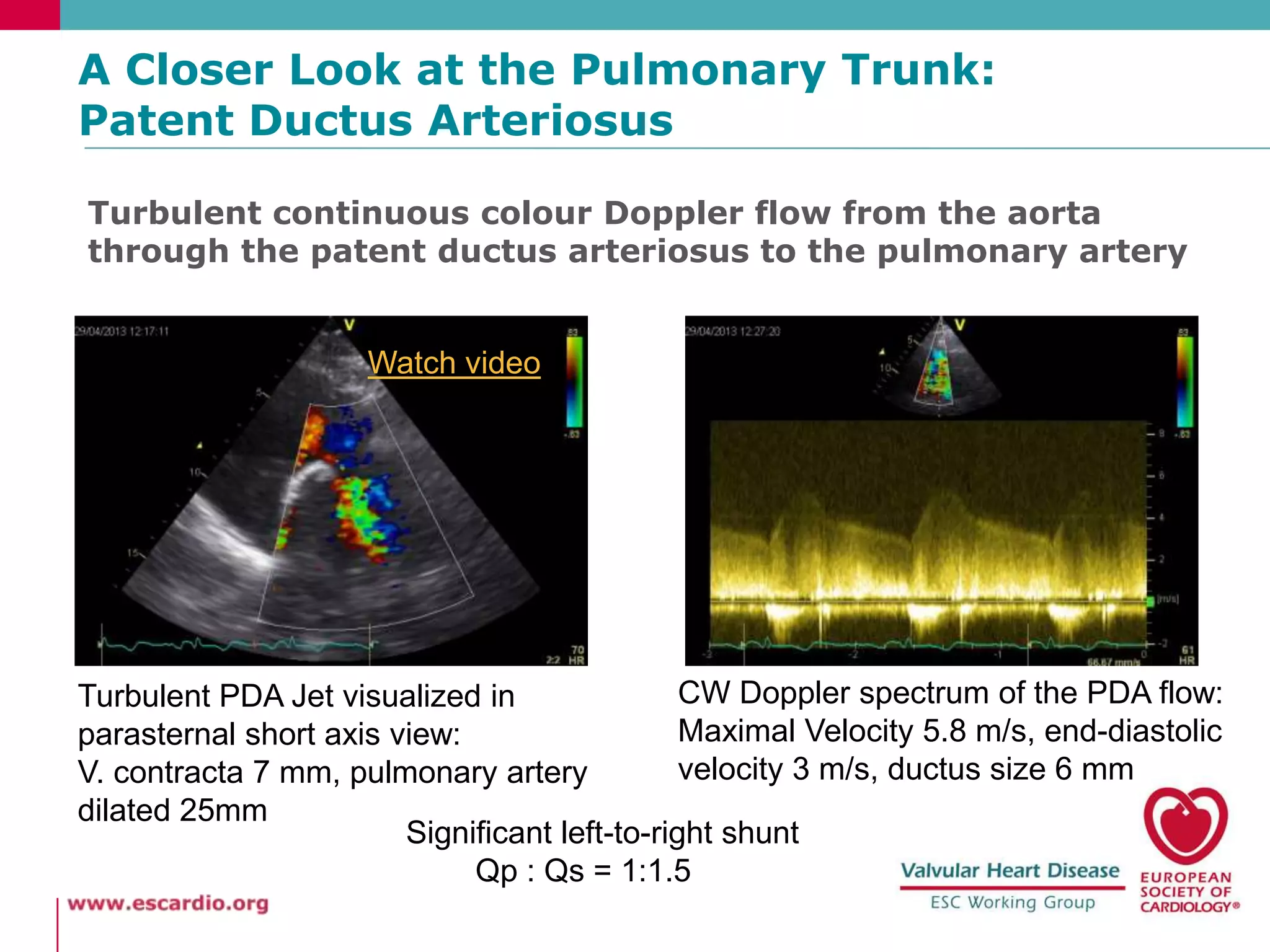 An Unusual Cause of Left Ventricular Volume Overload after Aortic Valve ...
