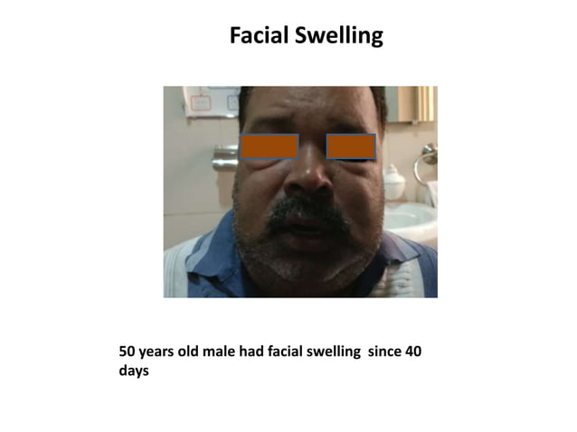 Unusual cause of facial swelling | PPTX