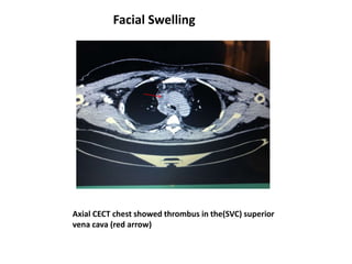 Unusual cause of facial swelling | PPTX