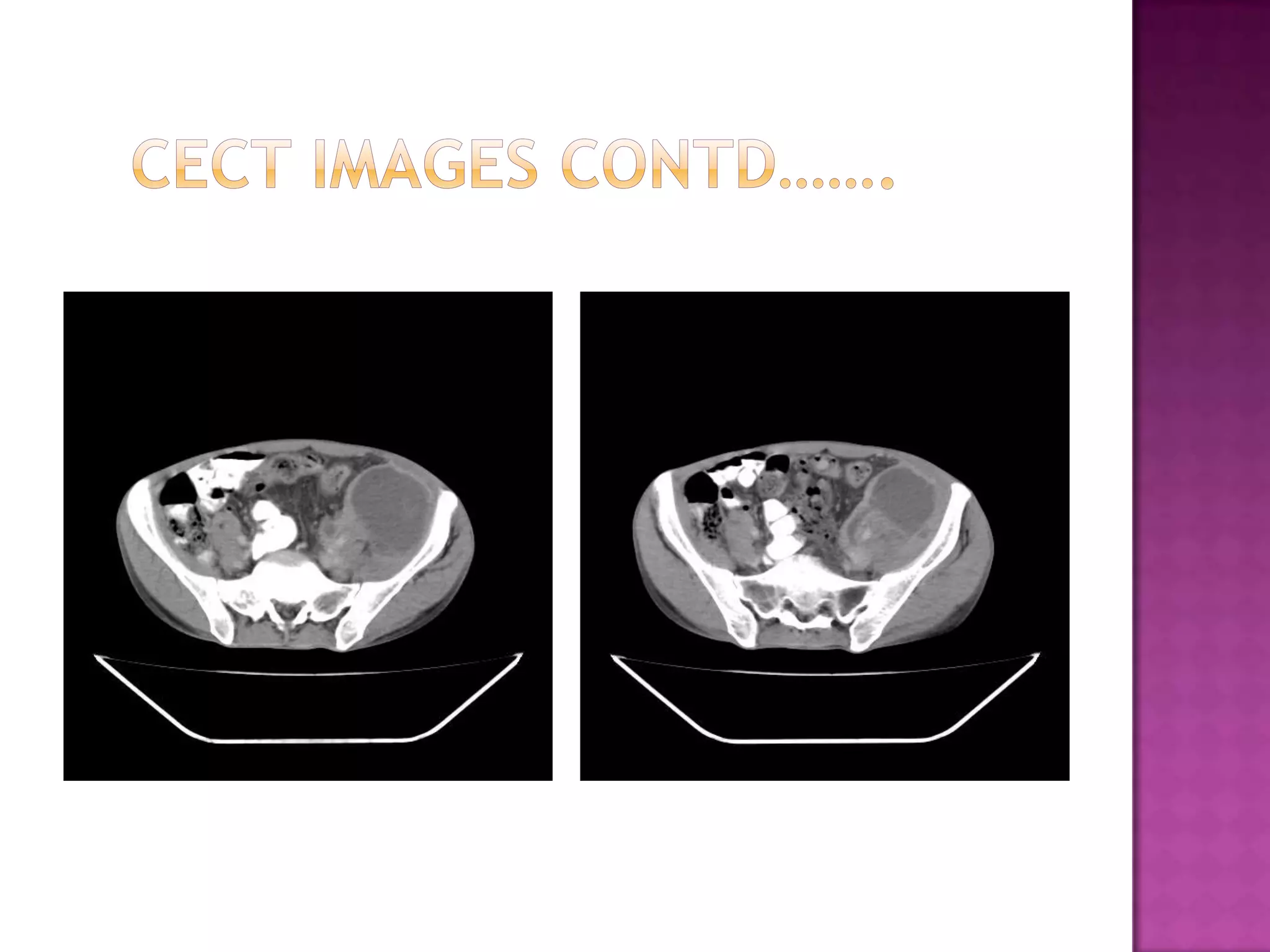 Unusual Presentation Of Psoas Abscess A Case Ppt