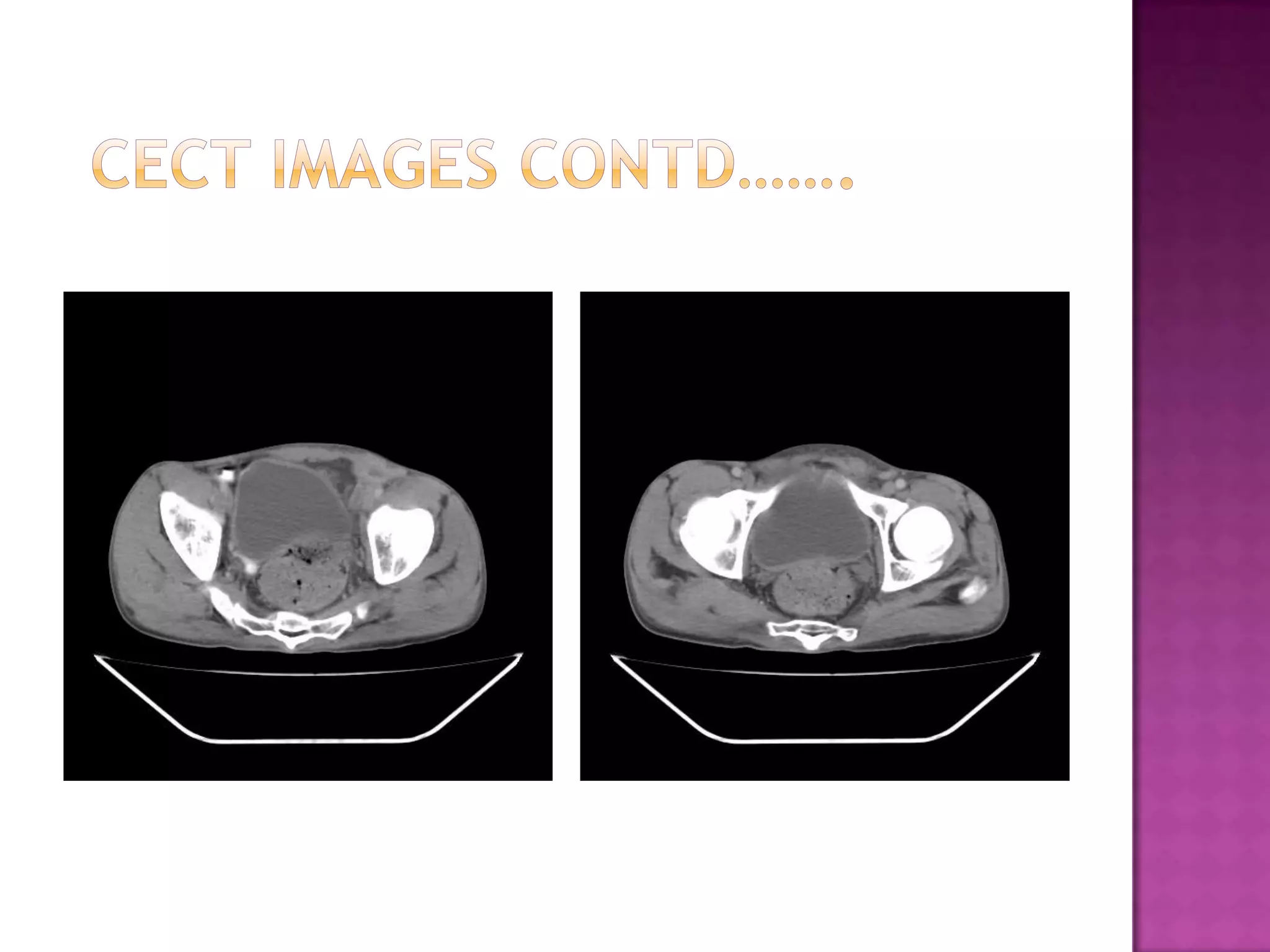 Unusual Presentation Of Psoas Abscess A Case Ppt