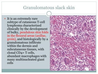 Unusual type and site of Lymphoma(Extranodal Lymphoma) Dr.Argha Baruah ...