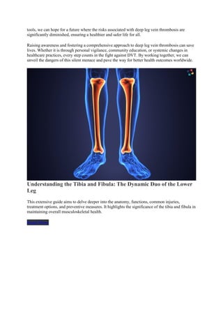 Deep Leg Vein Thrombosis (DVT): Meaning, Causes, Symptoms, Treatment ...