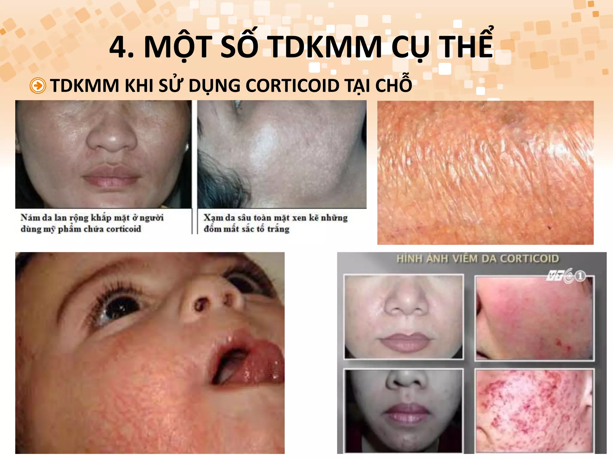 Adverse effects of Corticosteroids - Tác dụng KMM của các Glucocorticoid | PPTX