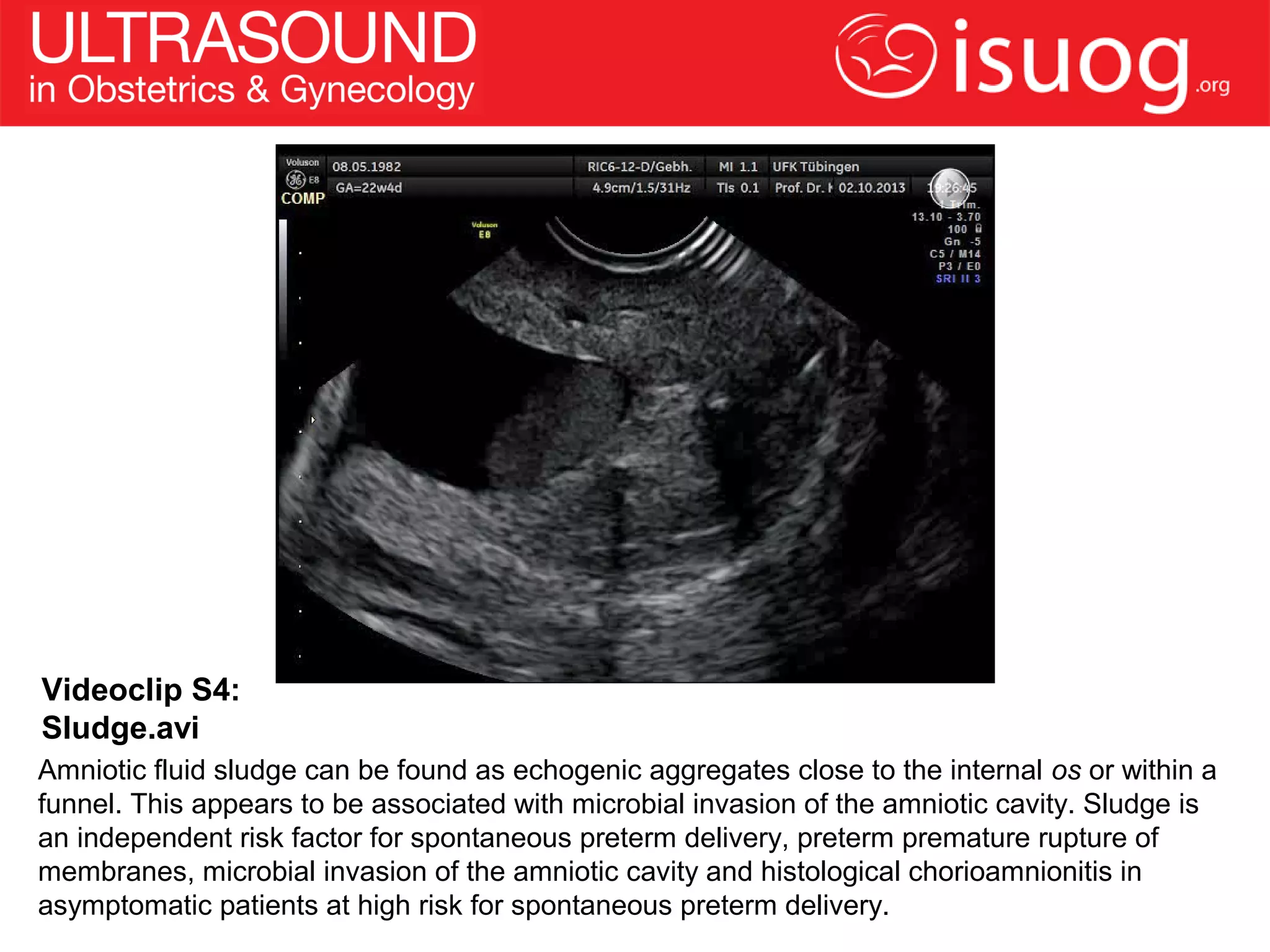 How to measure cervical length | PPT