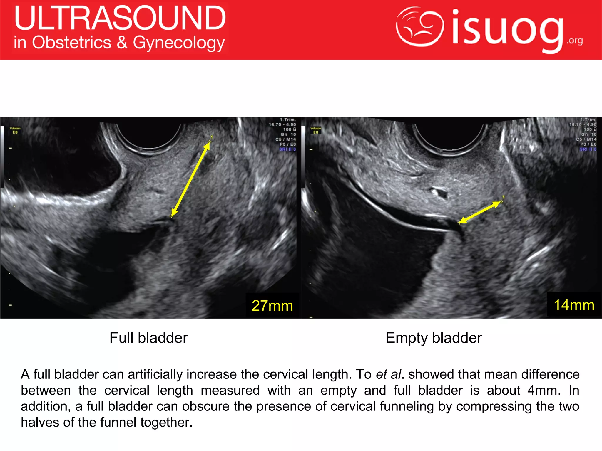 How to measure cervical length | PPT