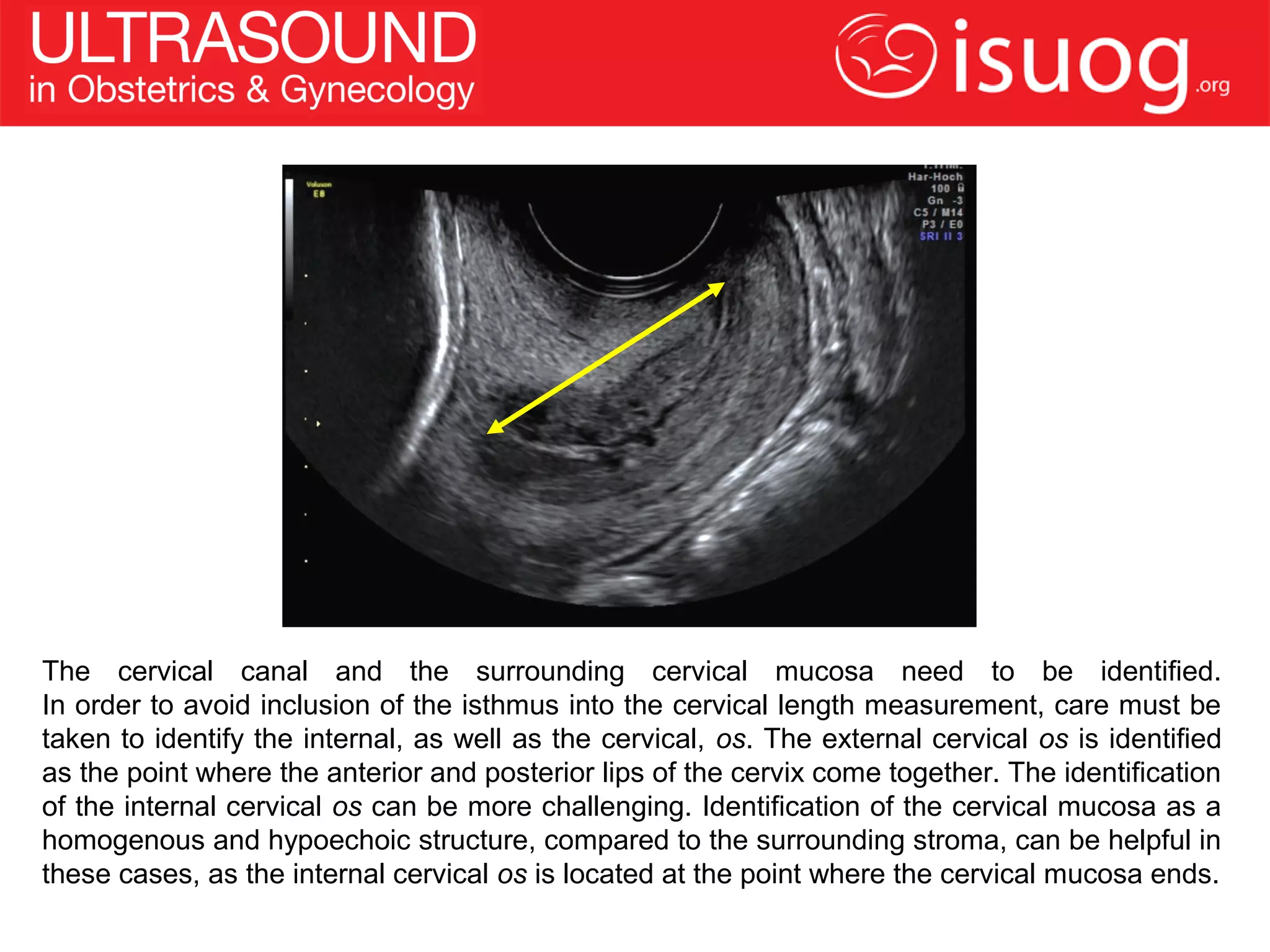 How to measure cervical length | PPT