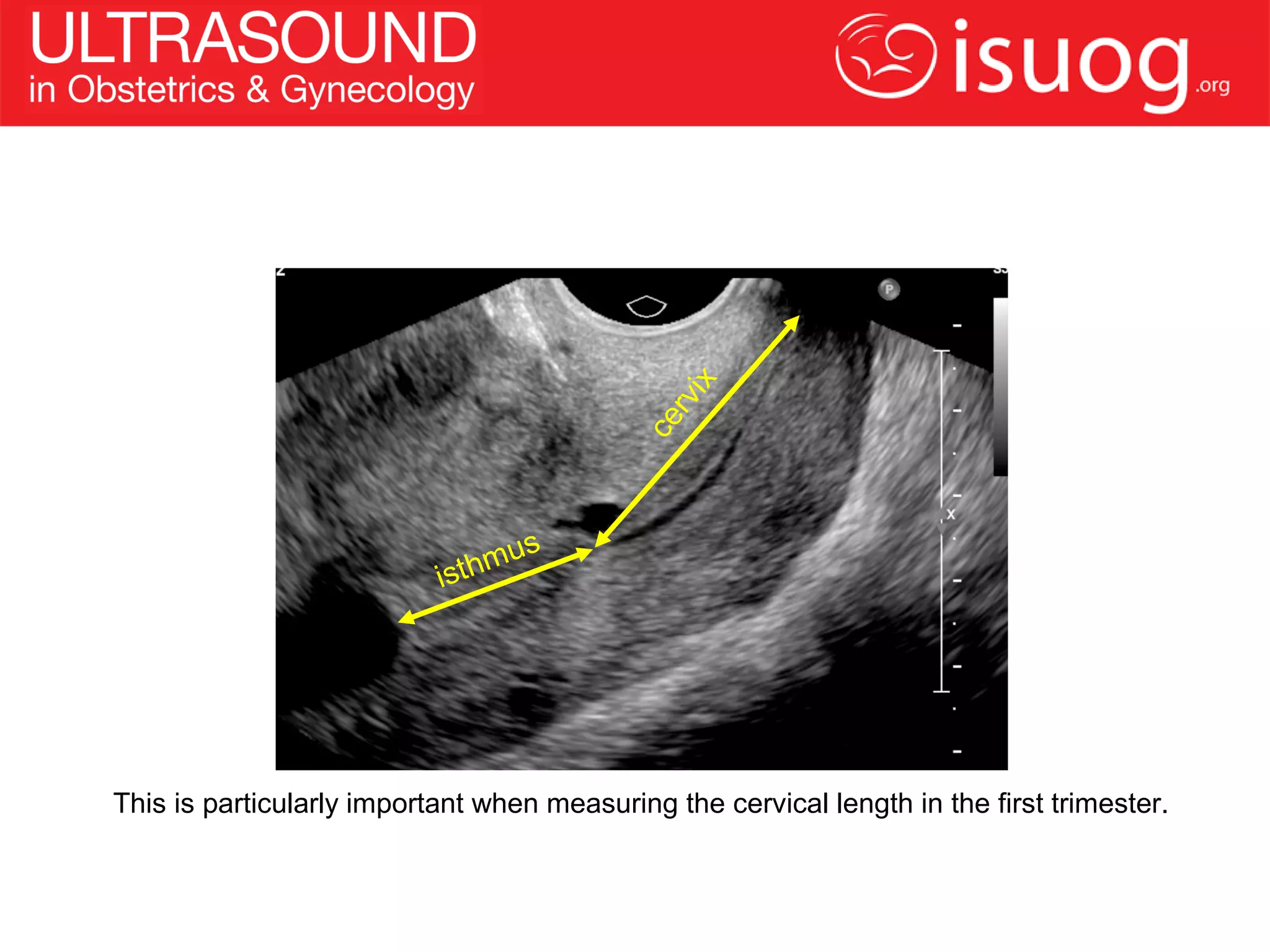How to measure cervical length | PPT