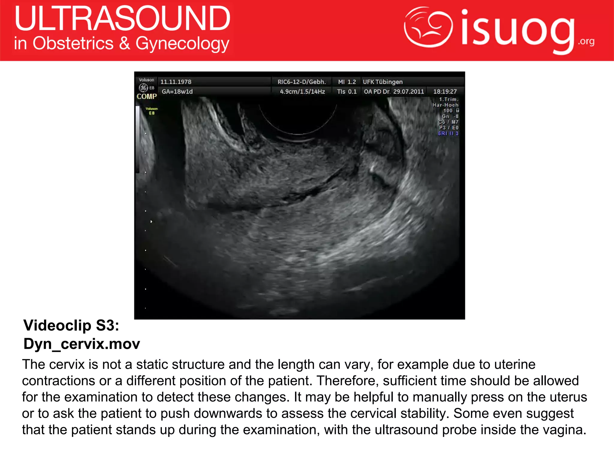 How to measure cervical length | PPT