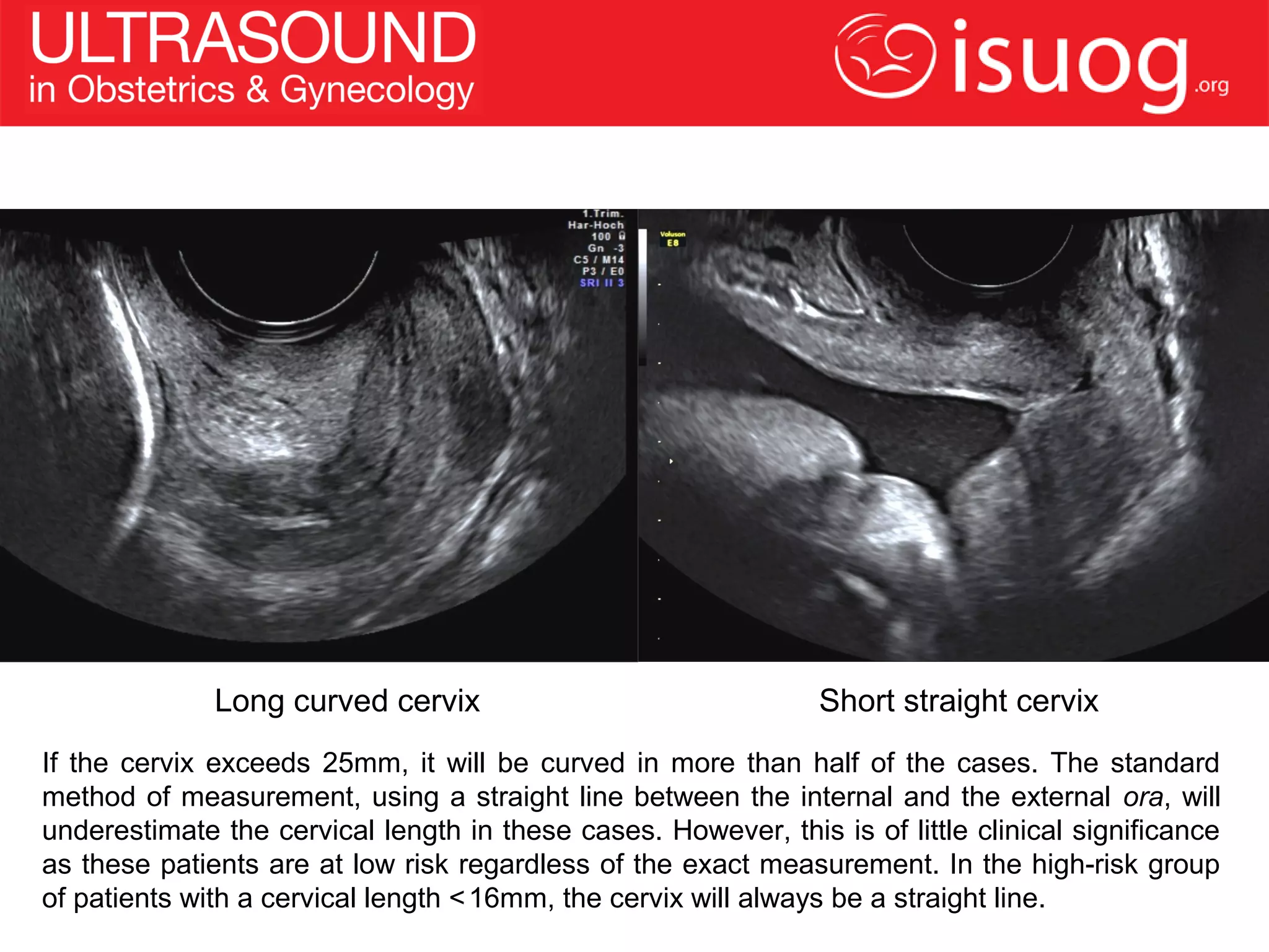 How to measure cervical length | PPT
