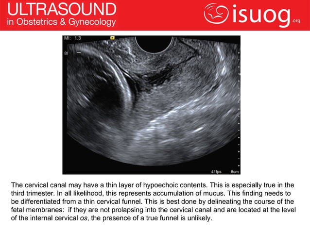 How to measure cervical length | PPT | Pregnancy | Reproductive Health