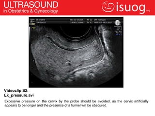 How to measure cervical length | PPT